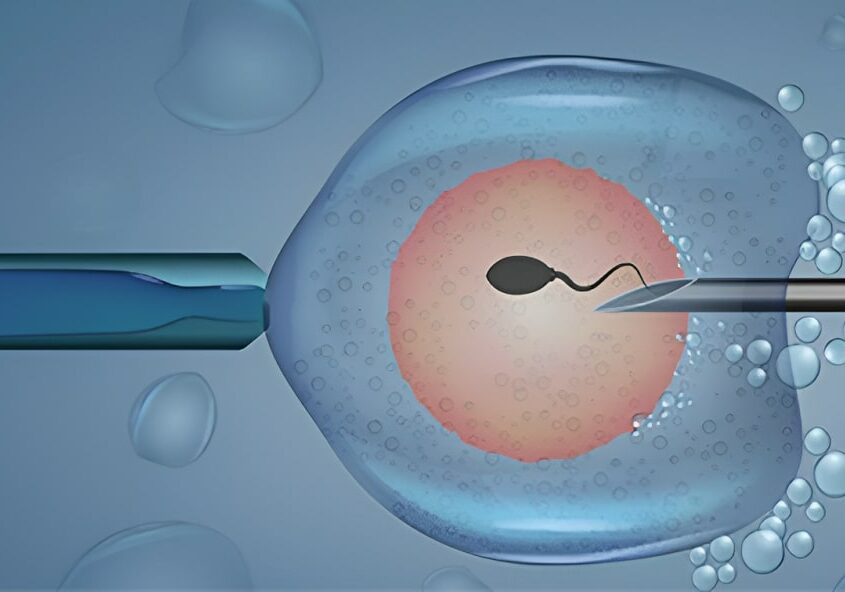Méthode ICSI : Comprendre le Processus de Fécondation Assistée